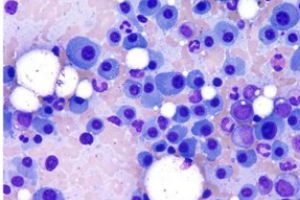 Early data show promise of BMS’ mezigdomide in pre-treated MM | The ...